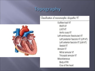 Idiopathic ventricular tachycardia | PPT