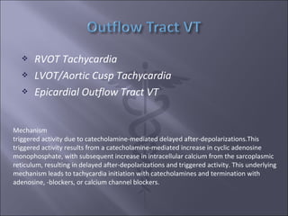 Idiopathic ventricular tachycardia | PPT