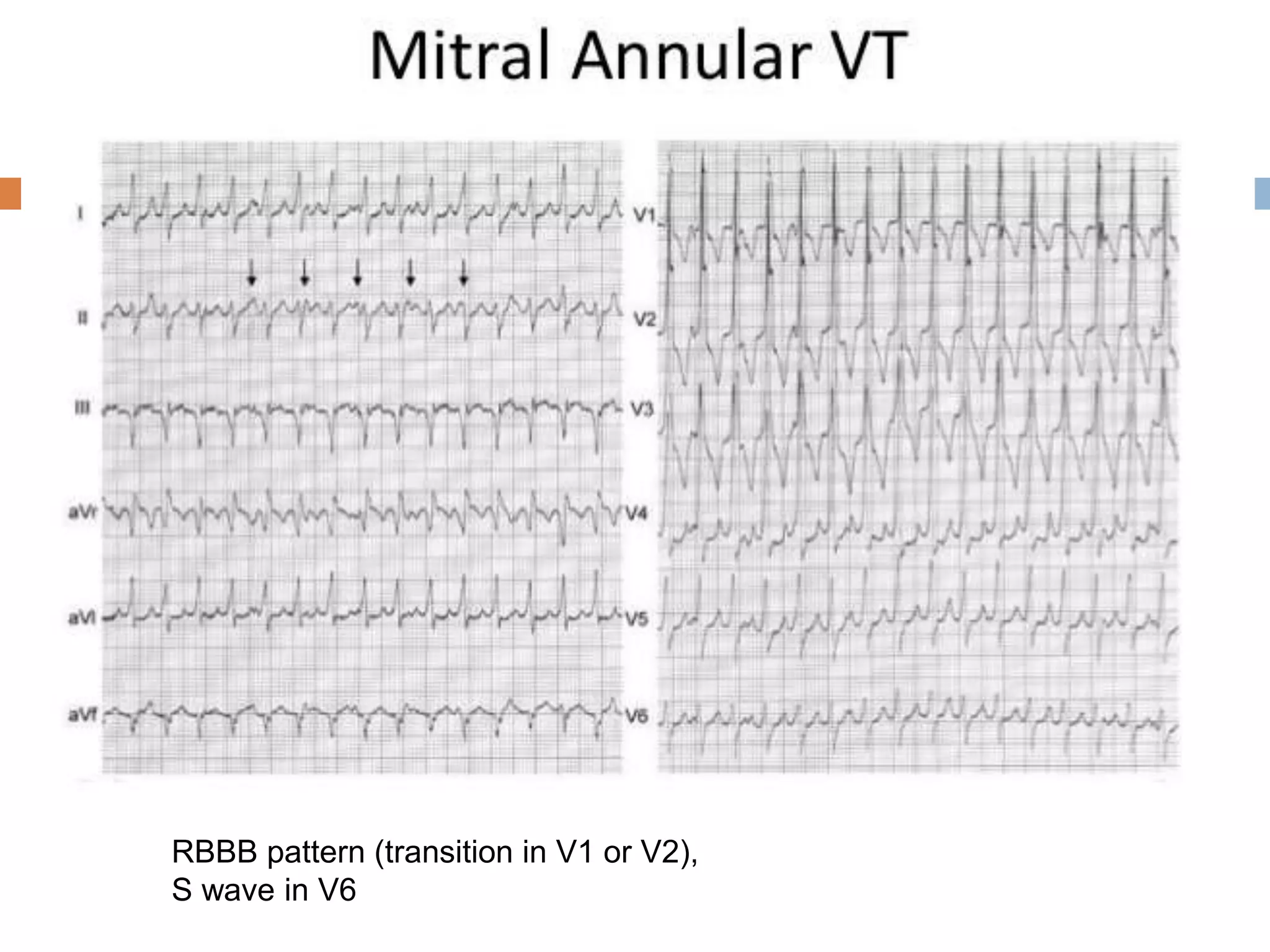 Idiopathic Ventricular Tachycardia (VT) | PPTX