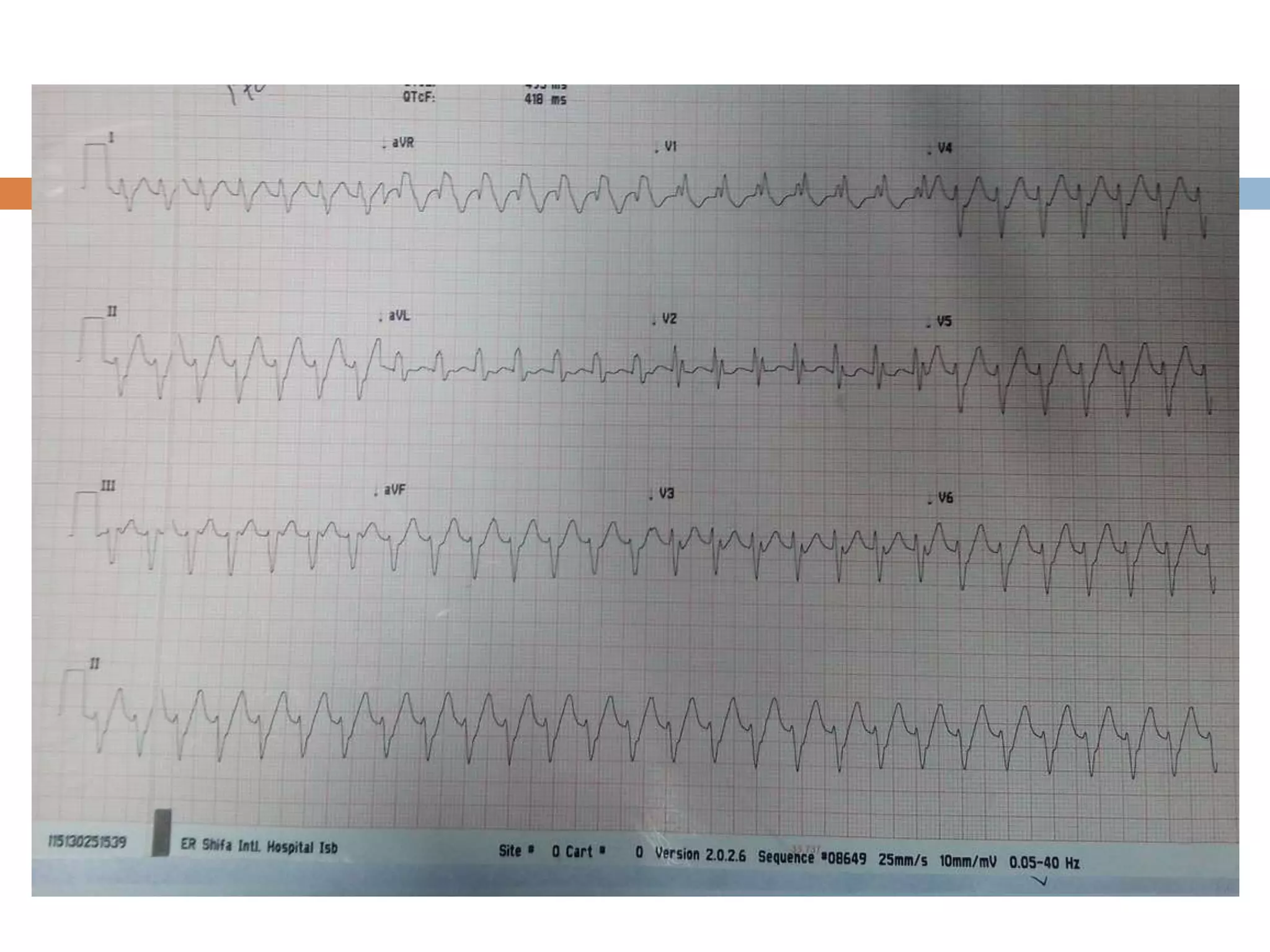 Idiopathic Ventricular Tachycardia (VT) | PPTX