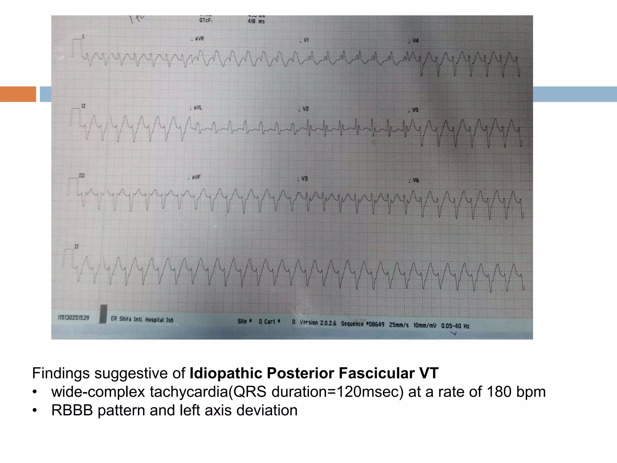 Idiopathic Ventricular Tachycardia (VT) | PPTX