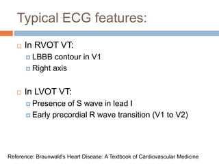 Idiopathic Ventricular Tachycardia (VT) | PPTX