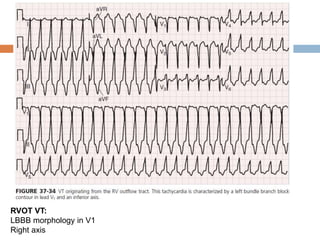 Idiopathic Ventricular Tachycardia (VT) | PPTX