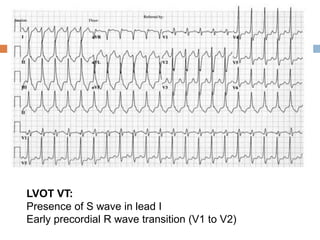 Idiopathic Ventricular Tachycardia (VT) | PPTX