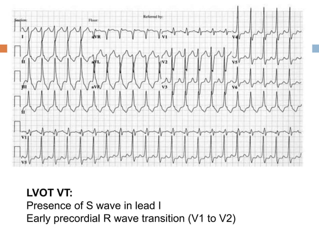 Idiopathic Ventricular Tachycardia (VT) | PPTX | Heart and ...