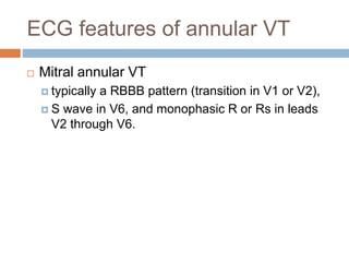 Idiopathic Ventricular Tachycardia (VT) | PPTX