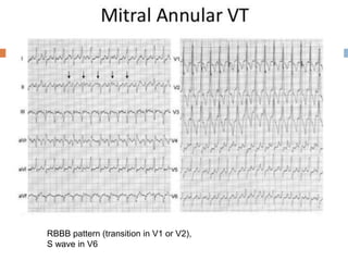 Idiopathic Ventricular Tachycardia (VT) | PPTX