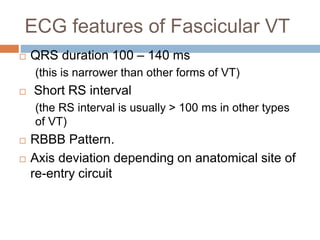 Idiopathic Ventricular Tachycardia (VT) | PPTX