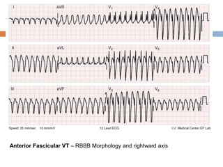 Idiopathic Ventricular Tachycardia (VT) | PPTX