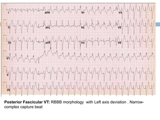 Idiopathic Ventricular Tachycardia (VT) | PPTX