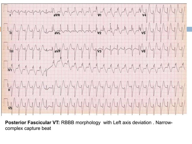 Idiopathic Ventricular Tachycardia (VT) | PPTX | Heart and ...
