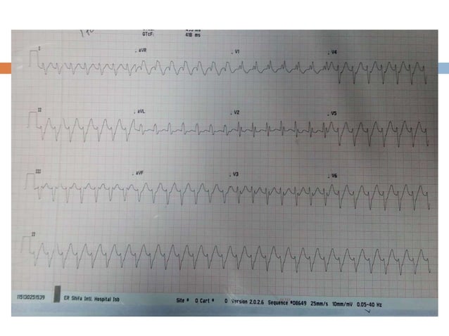 Idiopathic Ventricular Tachycardia (VT) | PPTX | Heart and ...