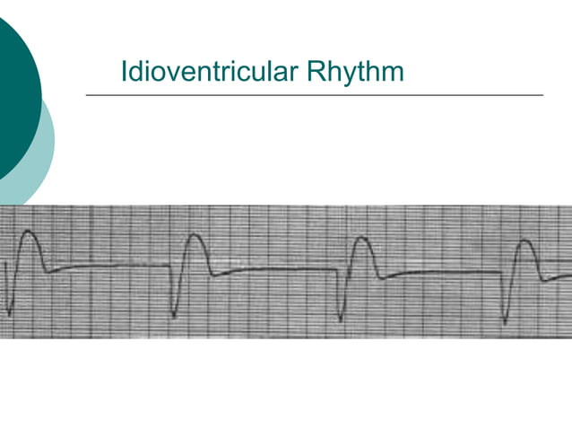 Idioventricular.ppt