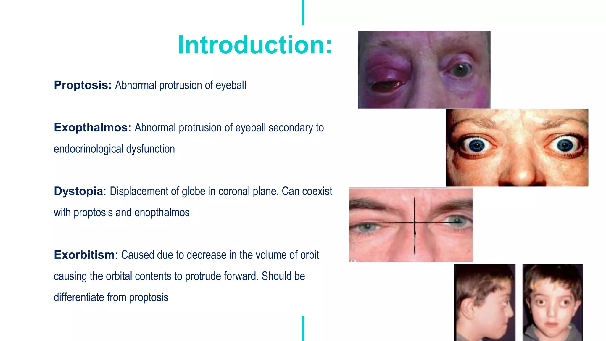 Approach to the case of PROPTOSIS | PPTX