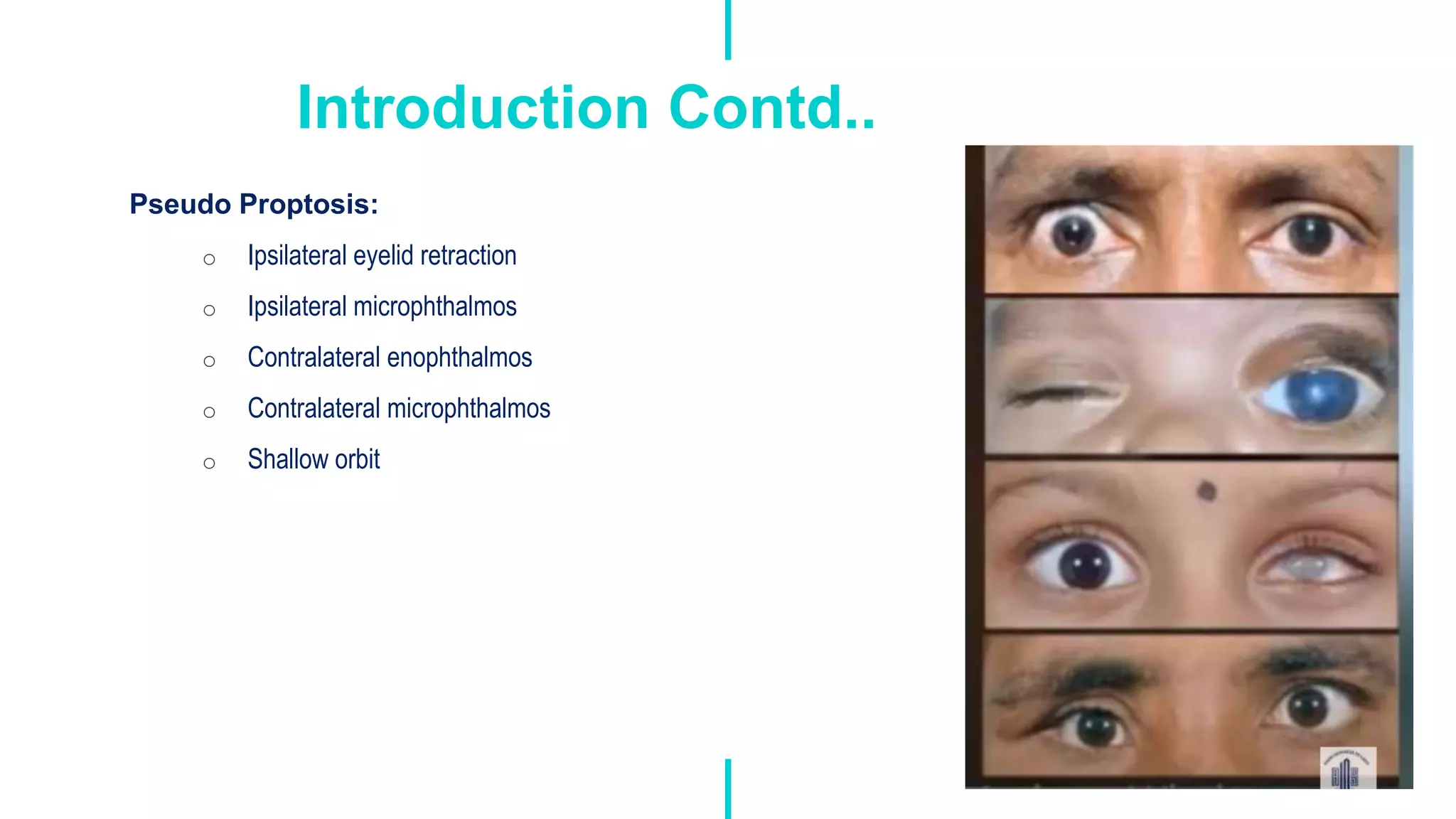 Approach to the case of PROPTOSIS | PPTX