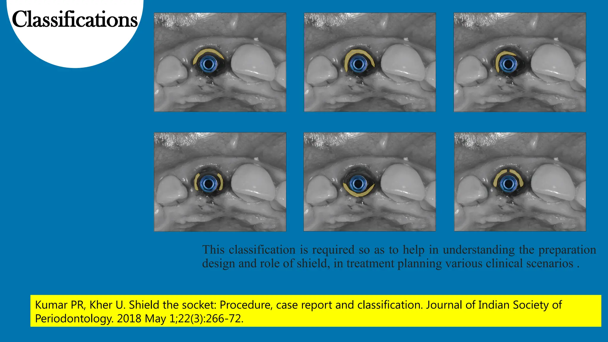 IDM SOCKET SHIELD TECHNIQUE IDM SOCKET SHIELD TECHNIQU.pptx