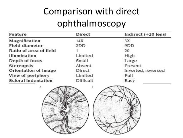 Indirect Ophthalmoscopy and slit lamp biomicroscopy