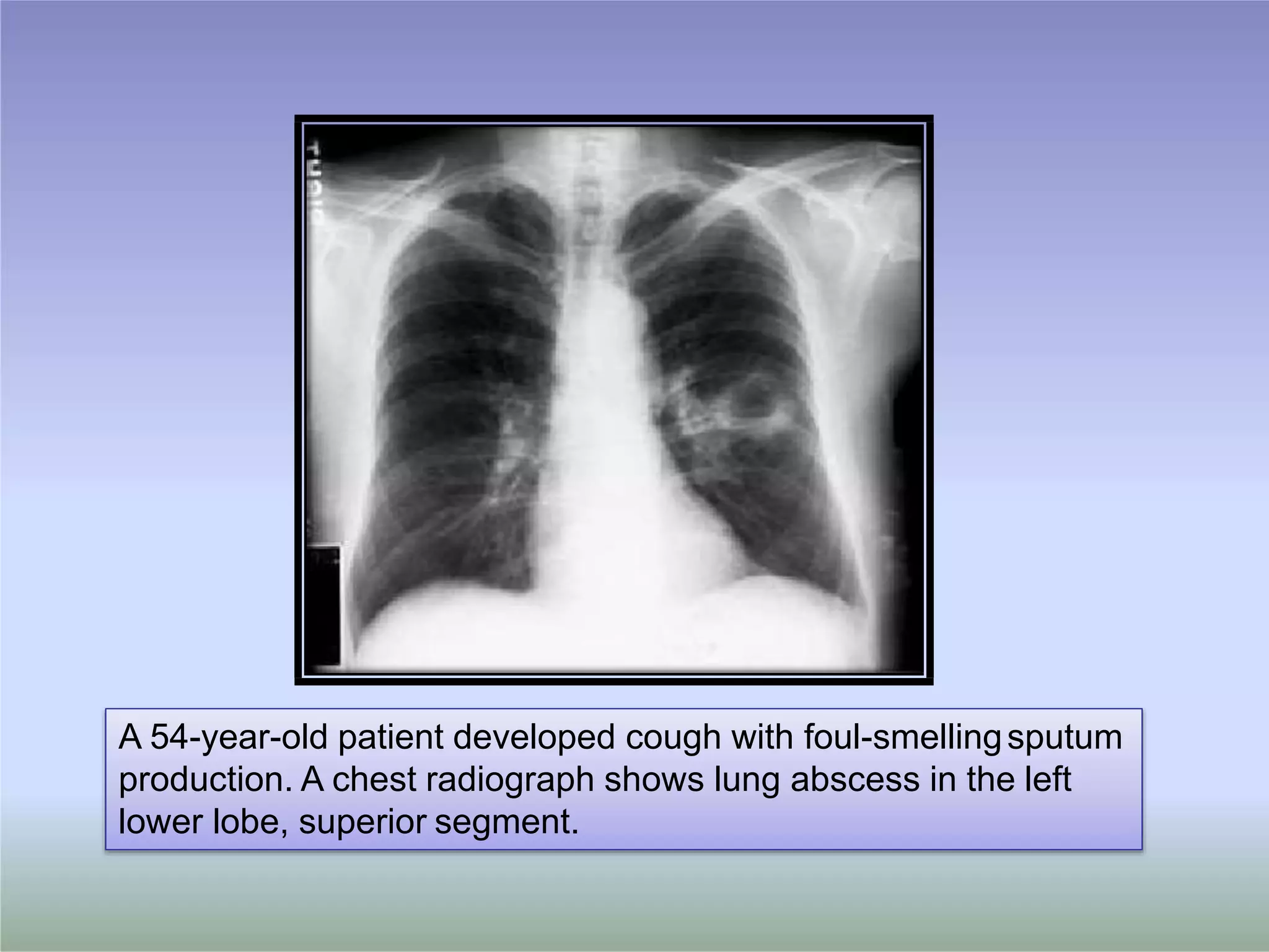 lung abscess | PPTX | Lung and Respiratory Health | Diseases and Conditions
