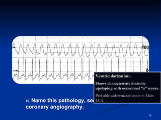 Id Pressure Waveforms | PPT