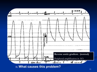 Id Pressure Waveforms | PPT