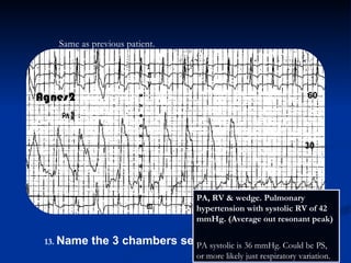 Id Pressure Waveforms | PPT