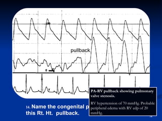 Id Pressure Waveforms | PPT