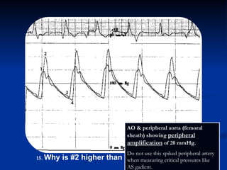Id Pressure Waveforms | PPT