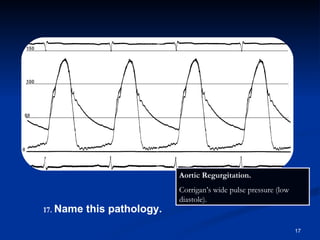 Id Pressure Waveforms | PPT