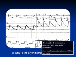 Id Pressure Waveforms | PPT