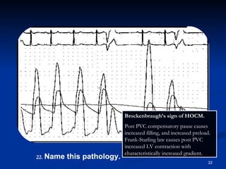 Id Pressure Waveforms | PPT