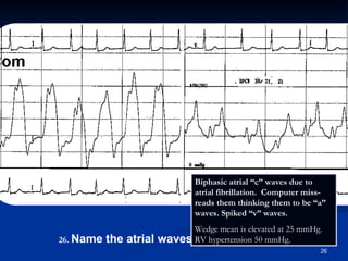 Id Pressure Waveforms | PPT