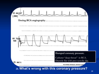 Id Pressure Waveforms | PPT