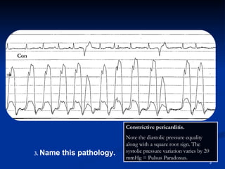 Id Pressure Waveforms | PPT