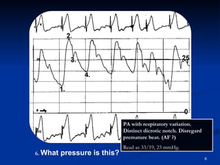 Id Pressure Waveforms | PPT