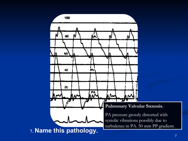 Id Pressure Waveforms | PPT