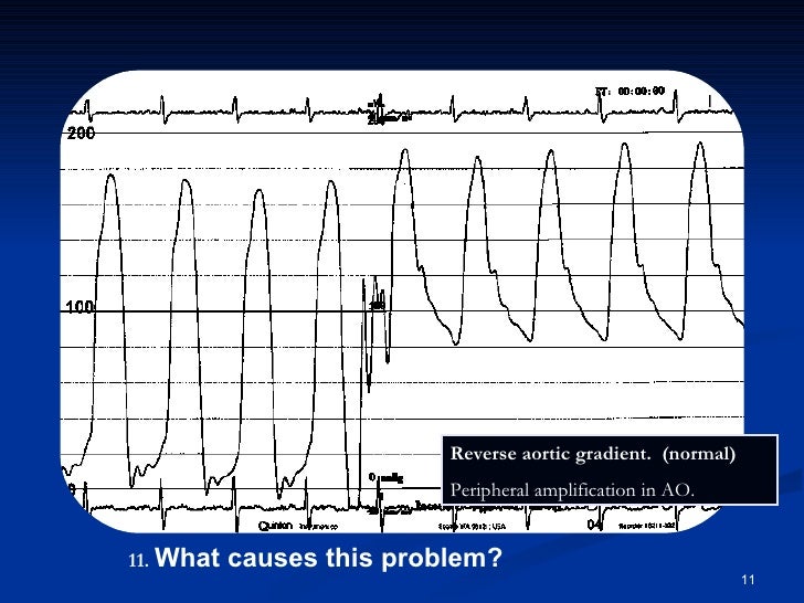 Id Pressure Waveforms