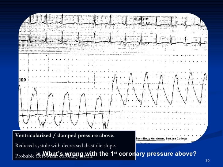 Id Pressure Waveforms