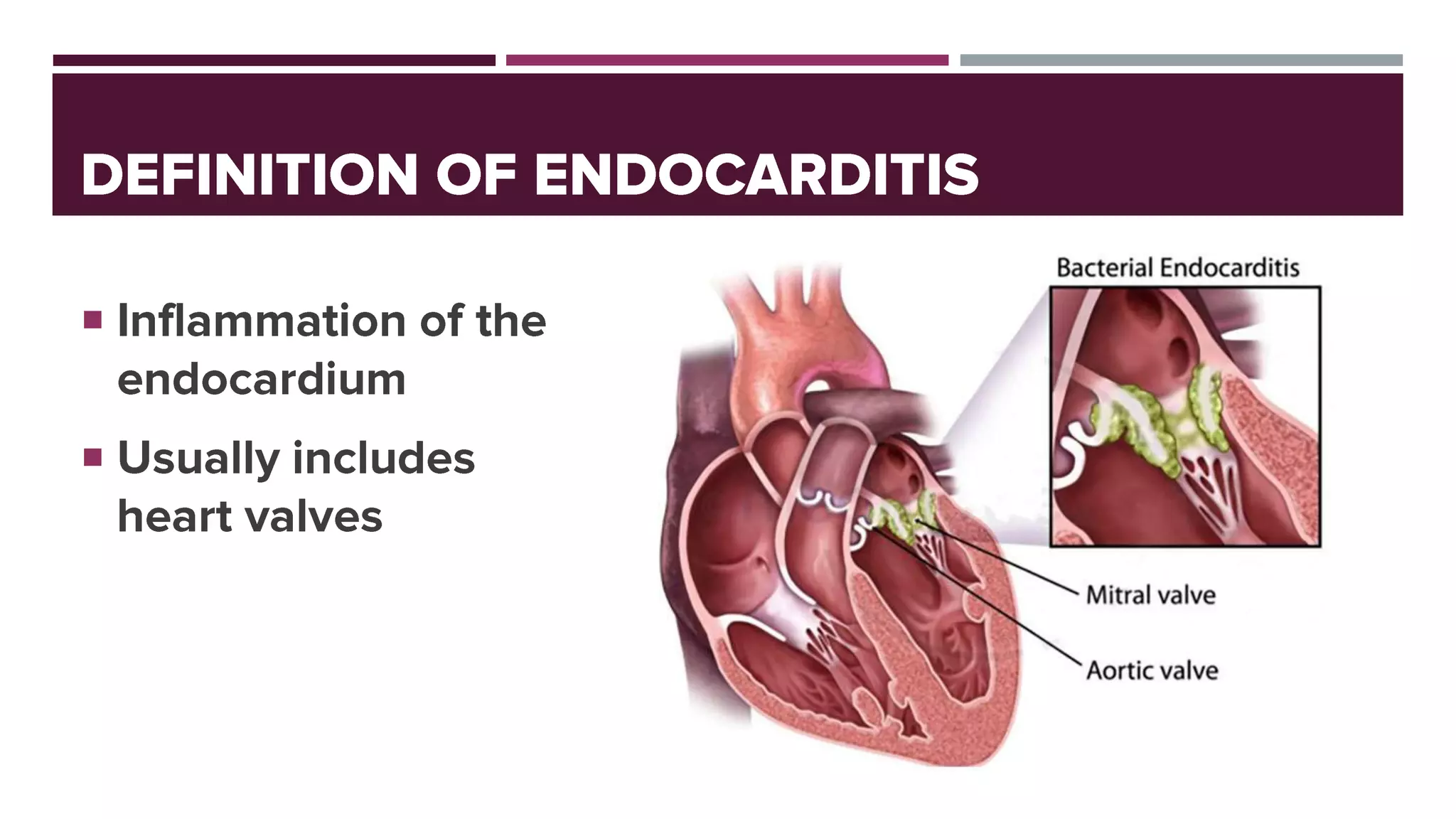 Infective Endocarditis | PPT