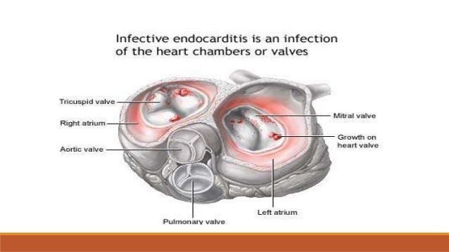 Infective endocarditis