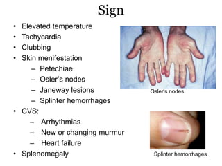 Bacterial Endocarditis Skin