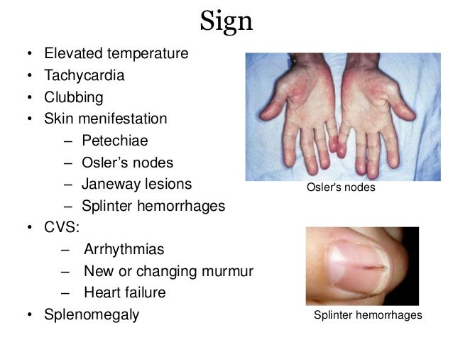 Bacterial Endocarditis Symptoms Endocarditis: Causes, Symptoms And