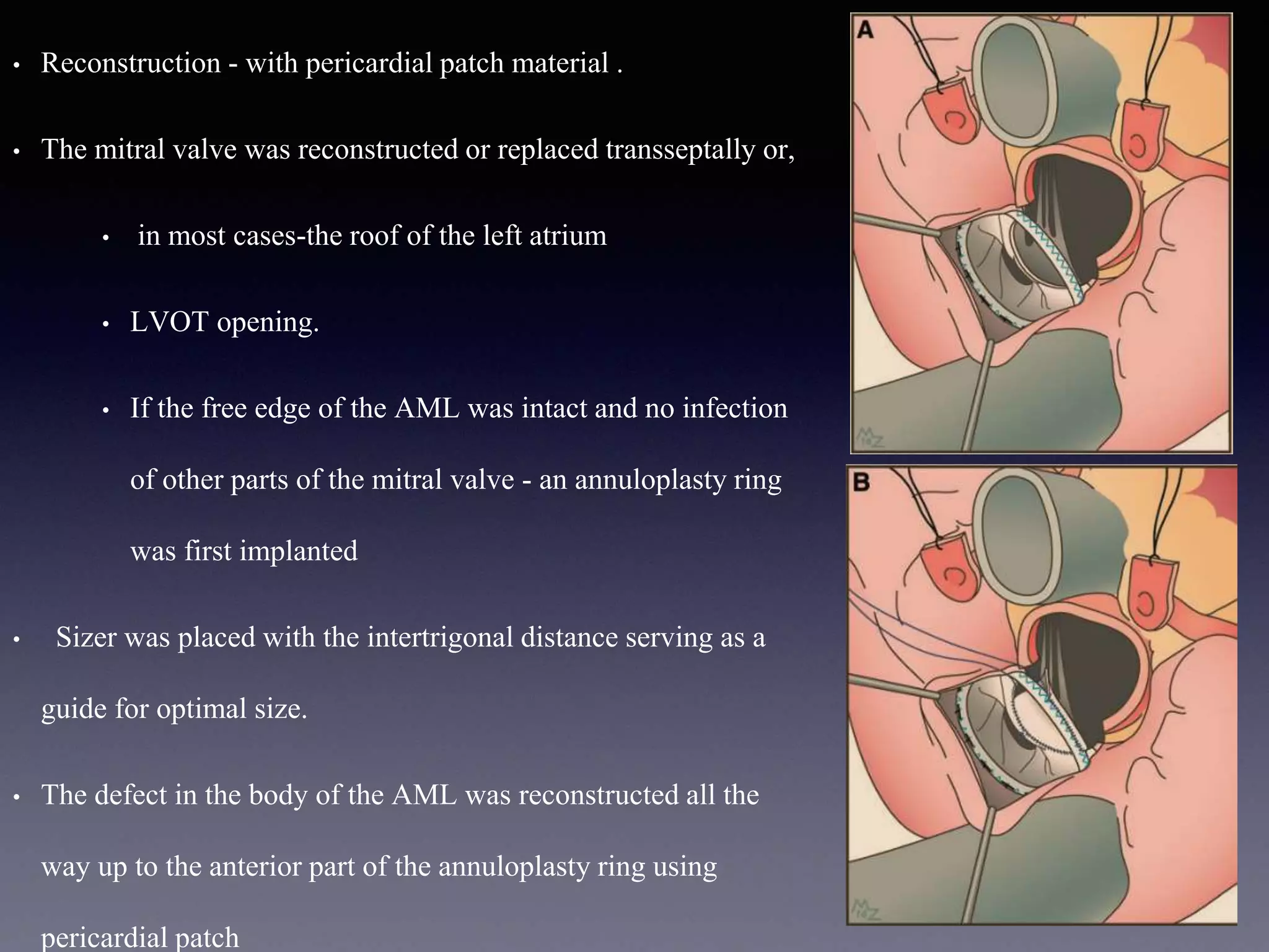 Extensive infective endocarditis of the aortic root and the aortic ...