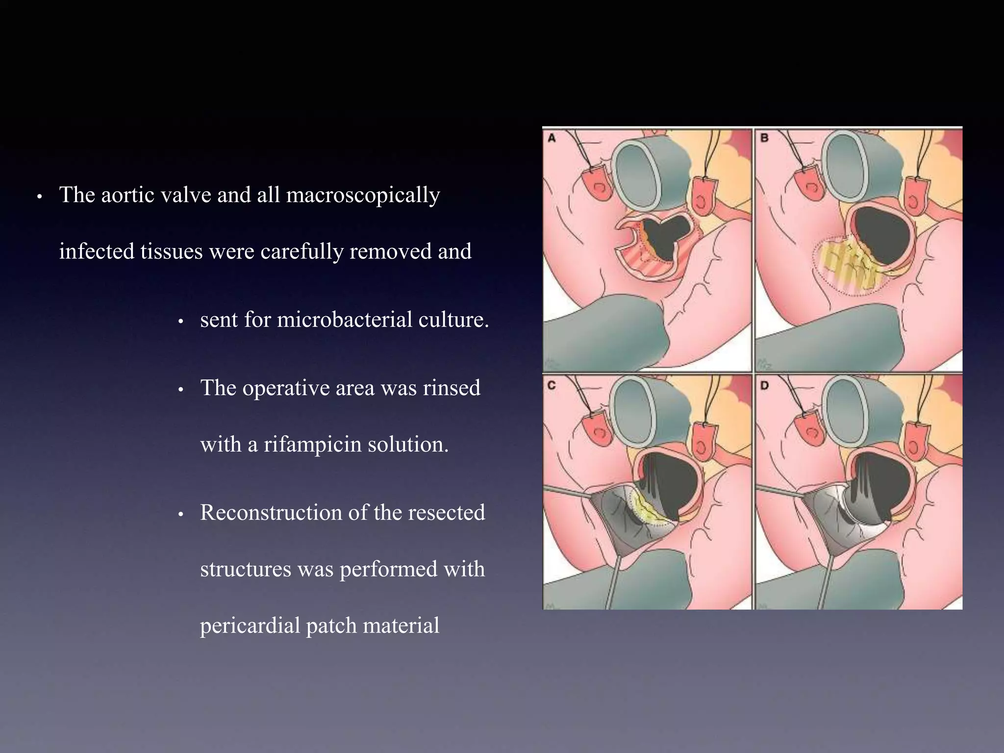 Extensive infective endocarditis of the aortic root and the aortic ...
