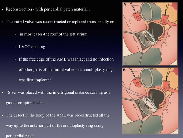 Extensive infective endocarditis of the aortic root and the aortic ...