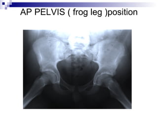 Ie 6 Pelvic Girdle | PPT | Death, Injury, or Military Conflict ...