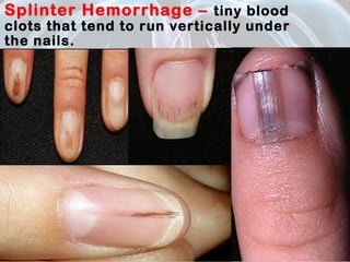 Infective Endocarditis | PPT