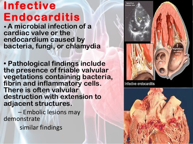 Infective Endocarditis