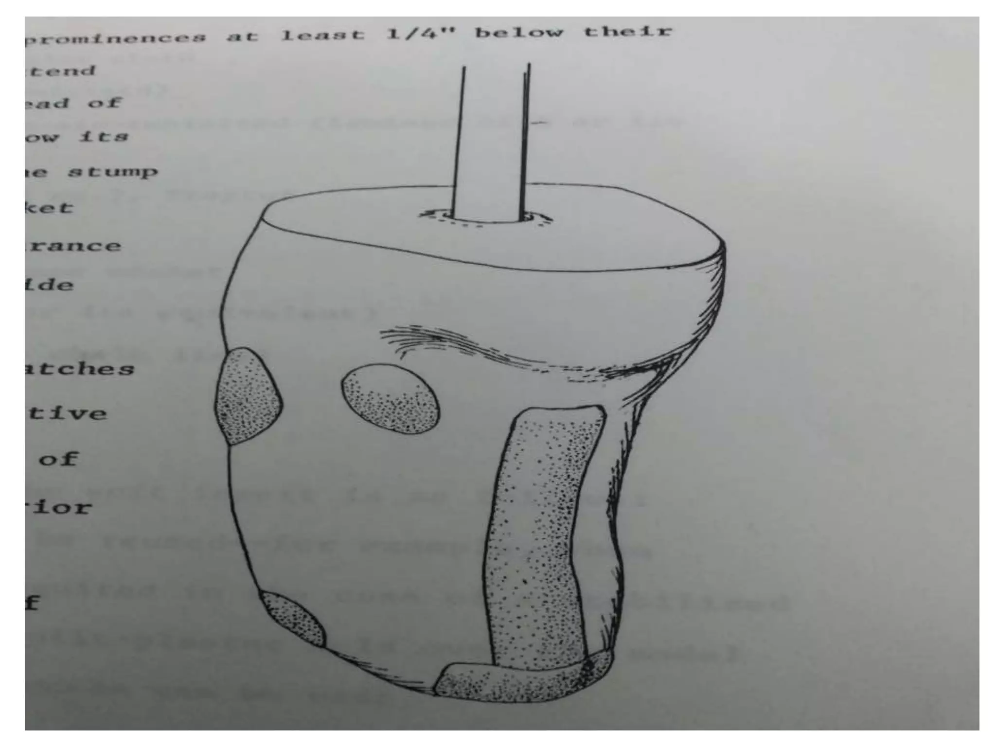 Patellar tendon bearing prosthesis | PPTX