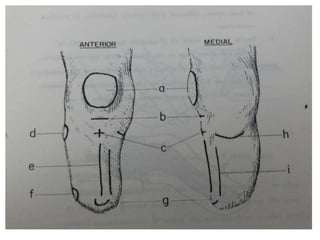 Patellar tendon bearing prosthesis | PPTX