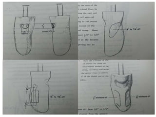 Patellar tendon bearing prosthesis | PPTX